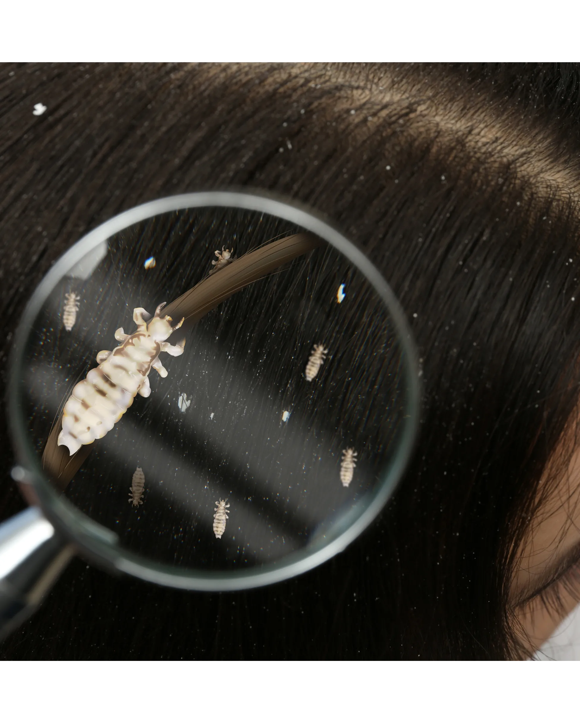 Lice Treatment in Powai | Effective Care by Dr. Reshma Ahuja